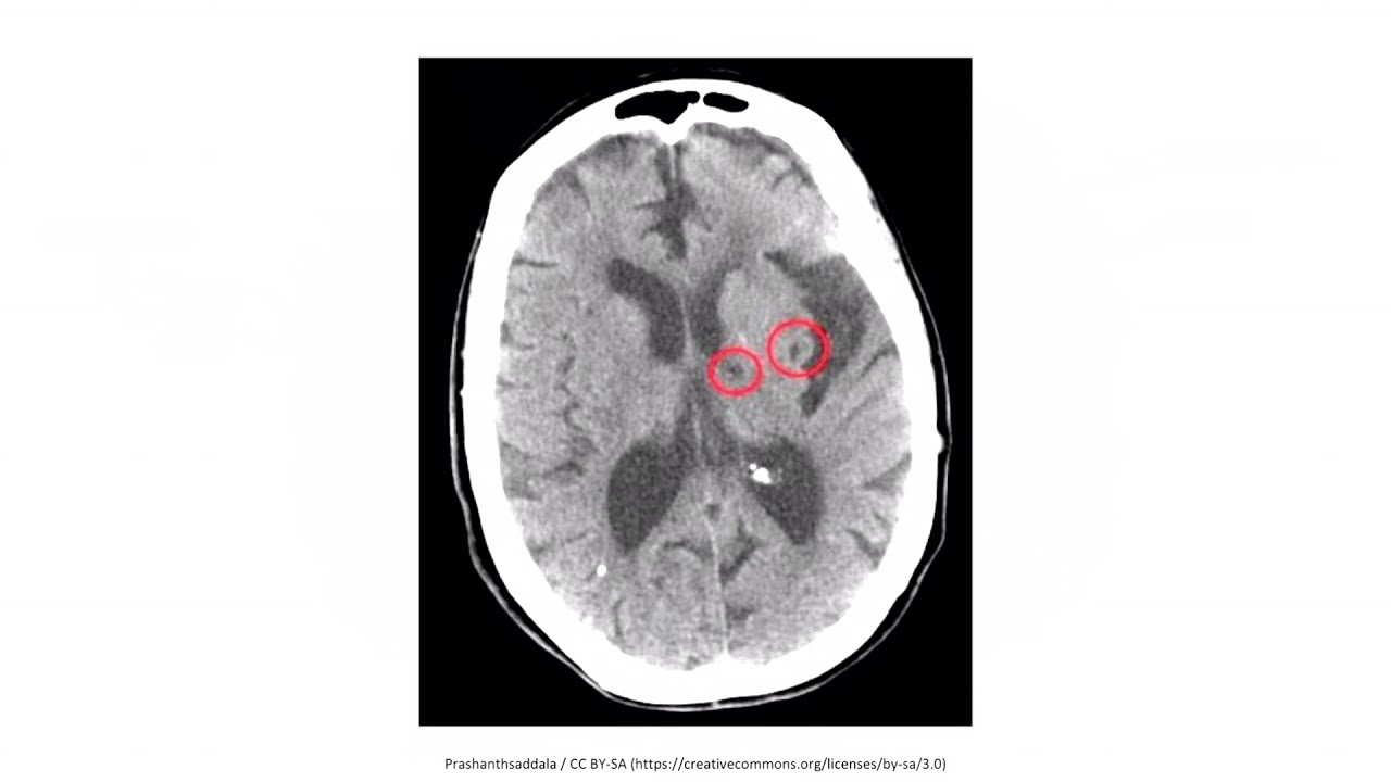 Cerebrovascular Disease for the USMLE Step 1