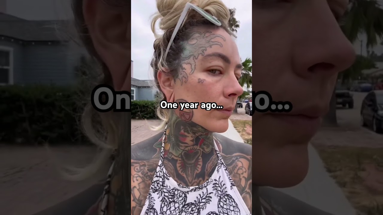 One year of tattoo removal progress