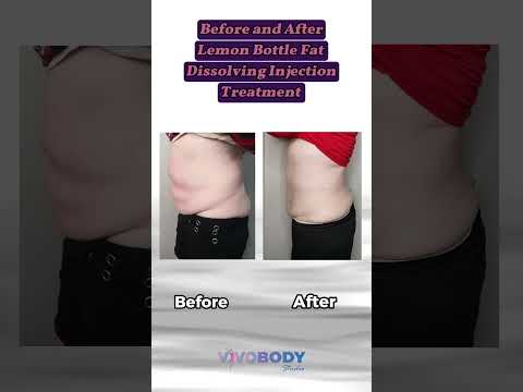 Lemon Bottle Fat Dissolving Injections Before and After #fatdissolve #injectables #fatreduction