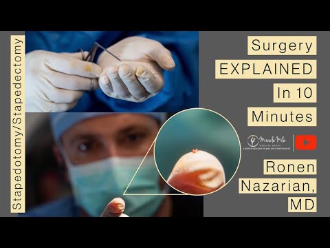 Stapedotomy / Stapedectomy EXPLAINED START TO FINISH in 10 minutes
