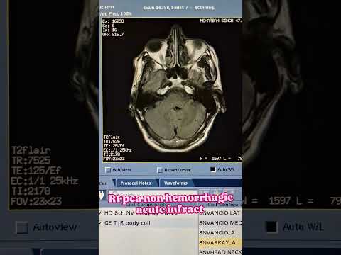 non hemorrhagic rt pca acute infarct #radiographer #youtubeshorts #humananatomy #trending #viral
