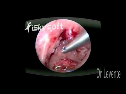 Tonsillotomy by shaver - An alternative surgical option to total tonsillectomy