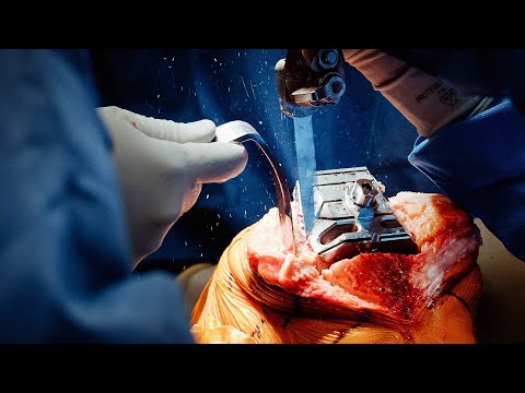 Total Knee Replacement Using Lantern® by Michael P. Ast, MD | Preview