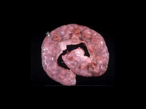 Gross Pathology of the Omentum and Mesentery