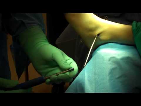 Dr. Patrick DeHeer, DPM - MBA Implant for Pediatric Flatfoot