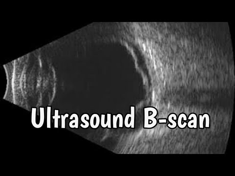Ultrasound B-scan #optometry #eye
