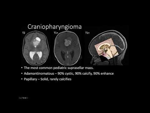 Imaging Sella and parasellar region
