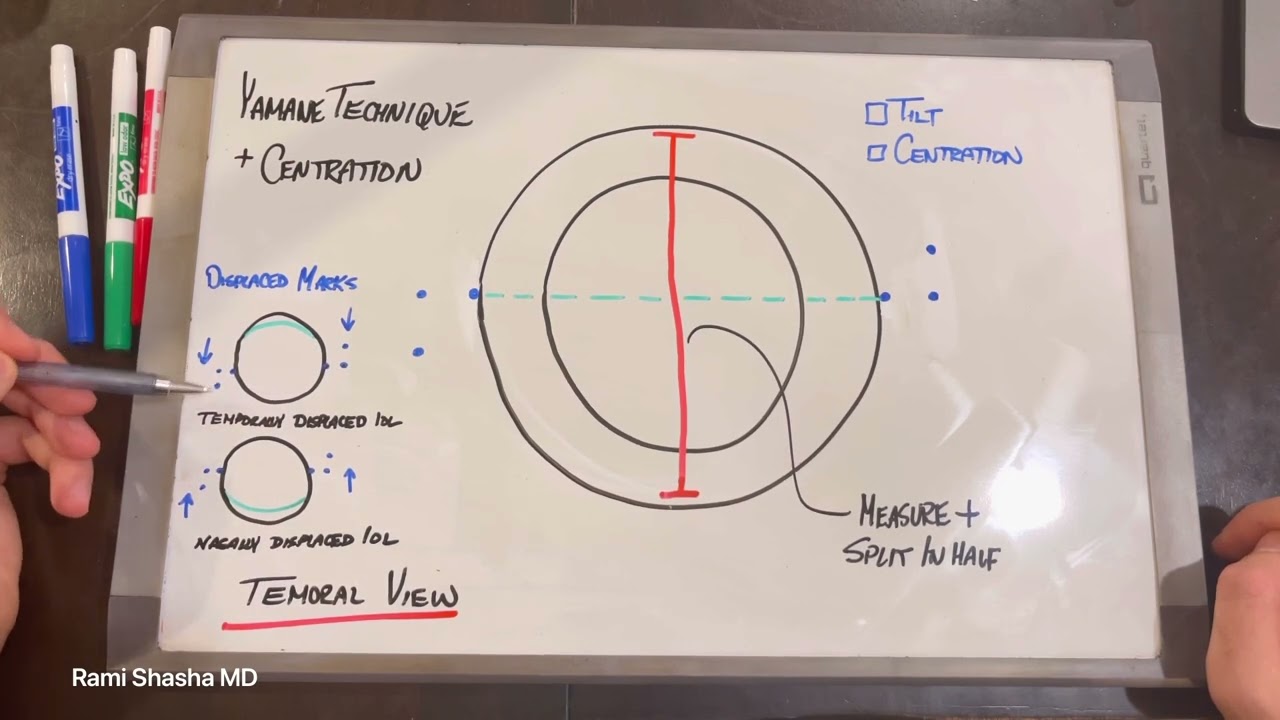 Yamane Technique & Centration