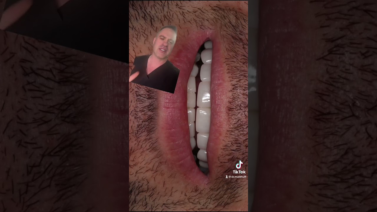 SMILE MAKEOVER #dentalmakeover #bestdentist #dentistry #transformation #allon4 #dentist