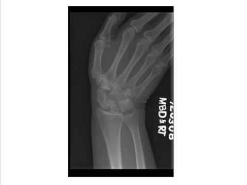 PA Wrist Scaphoid , ulnar diviation & axial « Medical Radiology ...