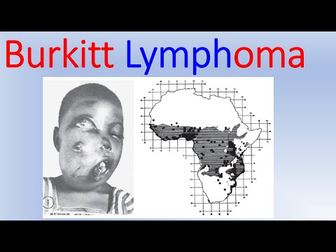 Burkitt lymphoma overview