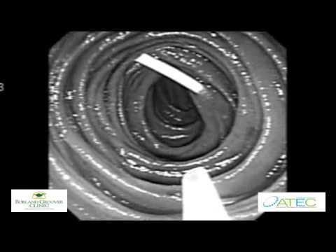 percutaneous endoscopic jejunostomy tube placement