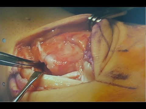 Ankle Injury #1B Explanation of Peroneal Tendon Injury with Images