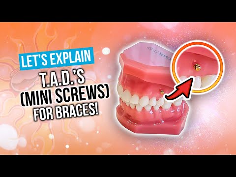 What are TADs (Miniscrews) with Braces... & Will You Need One?