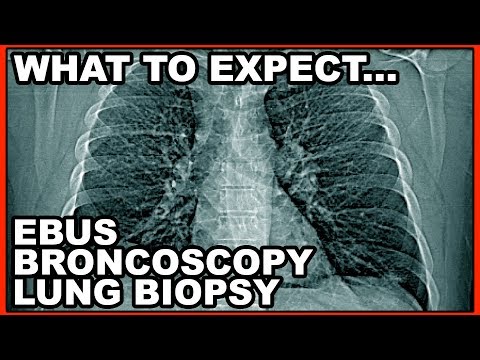What to expect Bronchoscopy Lung Biopsy EBUS Procedure