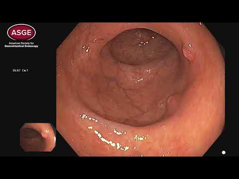 Diagnosing Juvenile Polyposis Syndrome