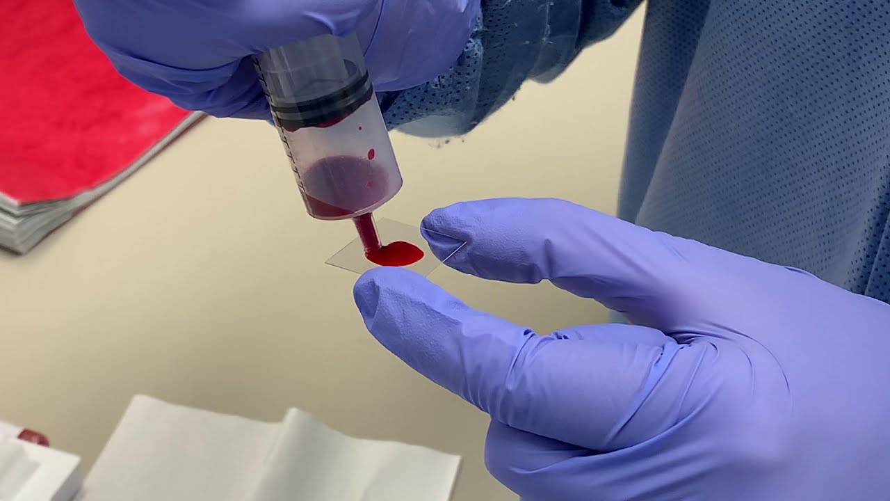 Bone marrow aspirate smear pull