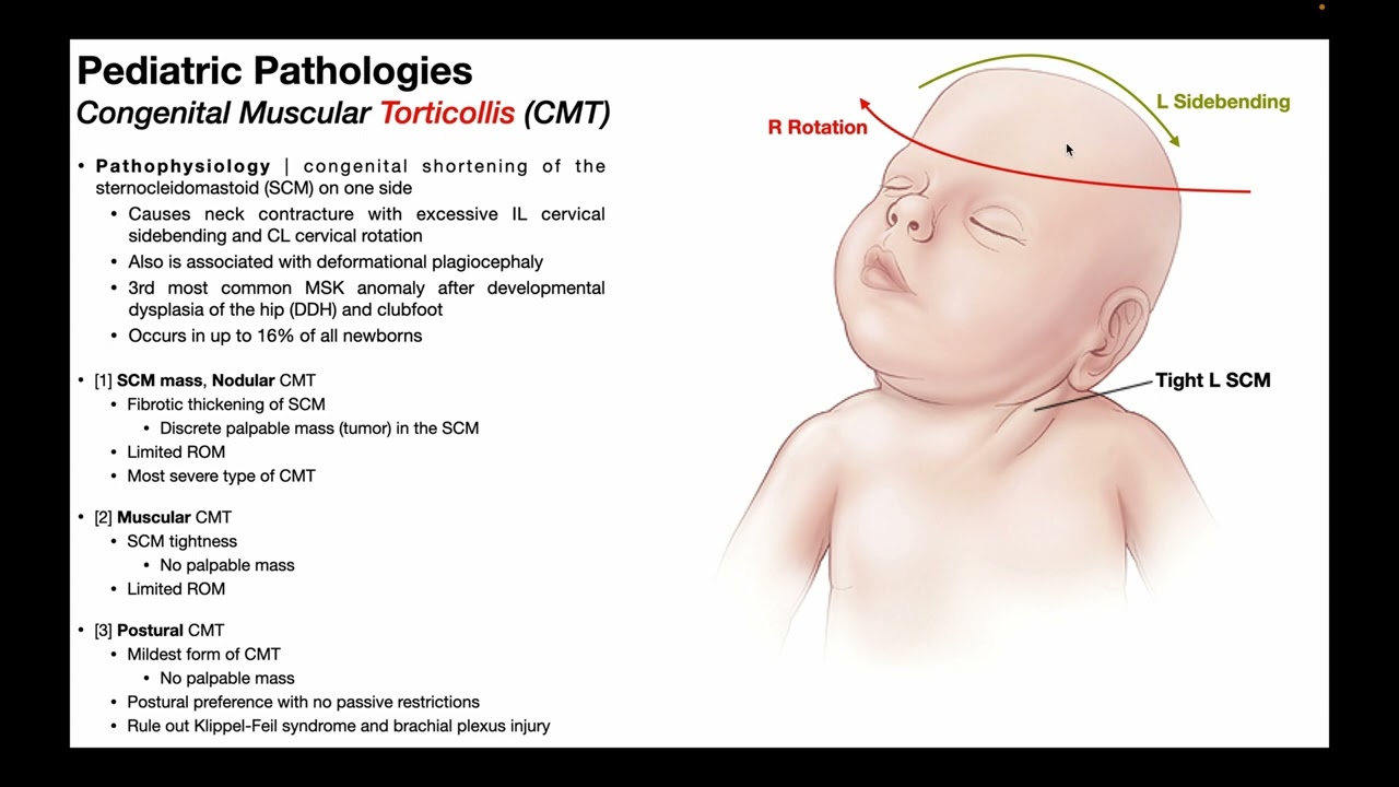 Torticollis → Mechanism, Pathophysiology, & Effects in Infants