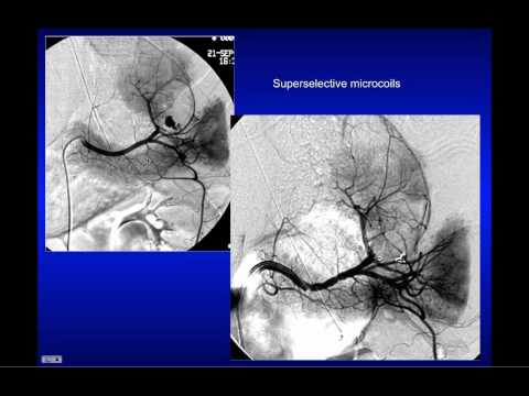 Endovascular Treatment of Solid Organ Trauma by Christopher Hannegan MD Part 2.mov