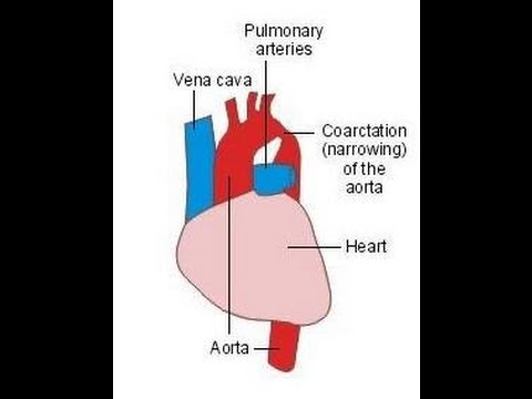 Coarctation of the Aorta