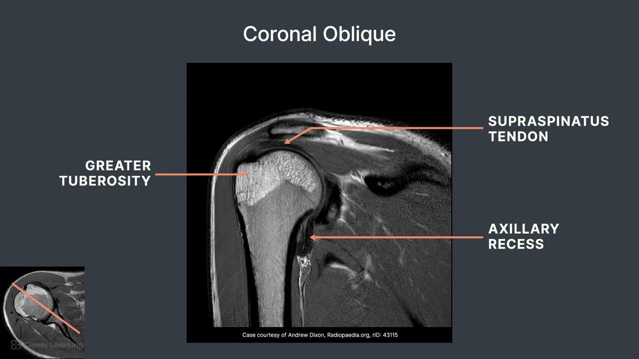 MRI Cross Sectional Anatomy of the Shoulder and Common Pathologies