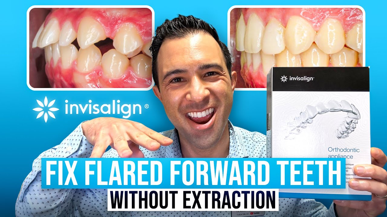 Fix Flaring Teeth WITHOUT Extractions!  Invisalign IPR Secret Revealed