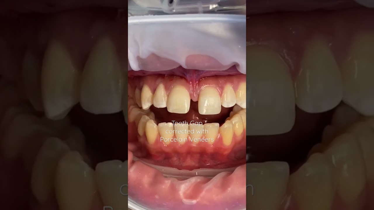 Tooth Gap Treatment with #porcelainveneers #diastasis #temporaryveneers