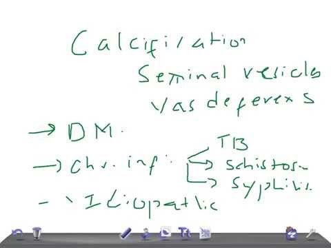 QUICK RADIOLOGY: Calcification of Seminal vesicles & Vas deferens