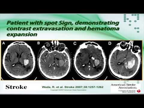 Intracerebral Hemorrhage by Sebastian Koch, MD