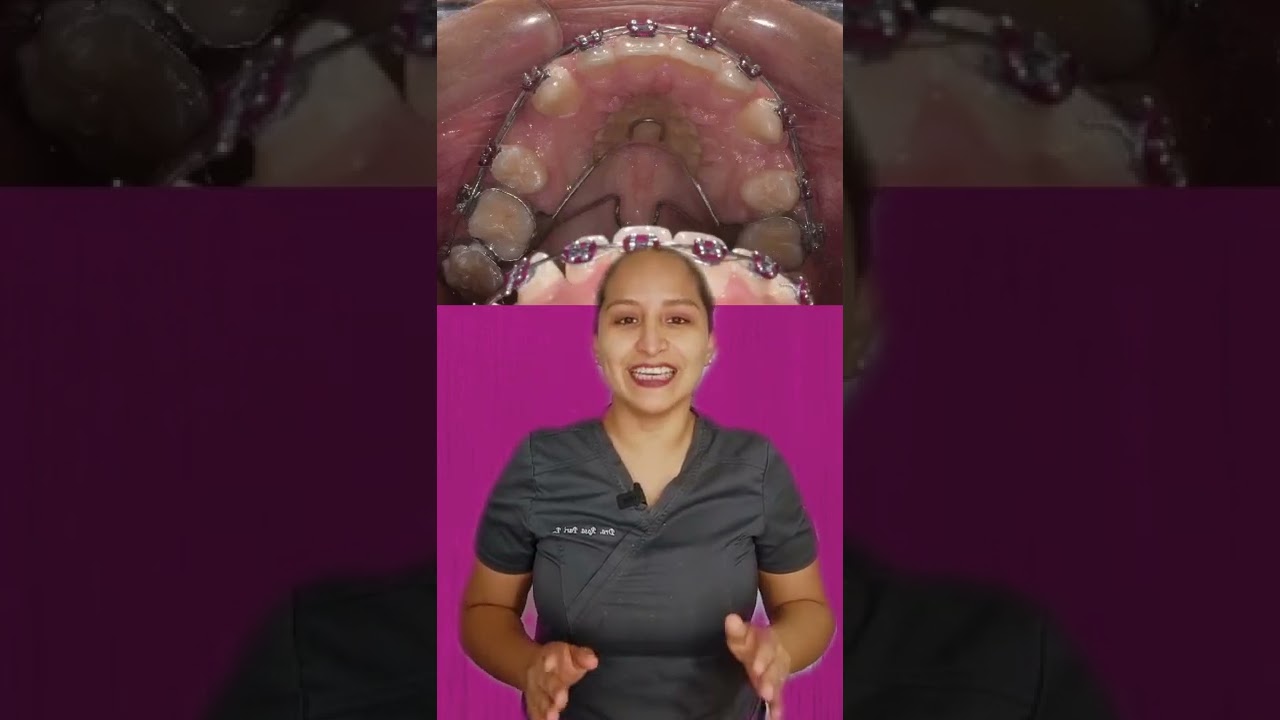 ✅ 🦷 ¡Botón de nance! 👦 💜