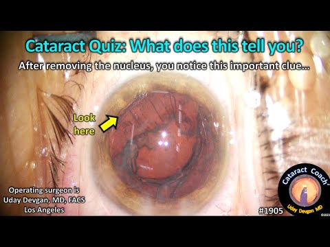 CataractCoach™ 1905: Cataract Quiz: What does this tell you?