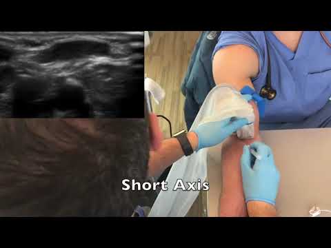 Ultrasound Guided Peripheral IV (PIV)