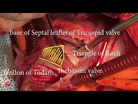 Internal anatomy of right atrium in an arrested heart
