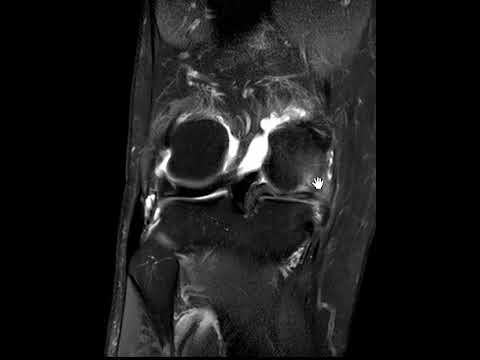 Chronic meniscus tear and knee arthritis
