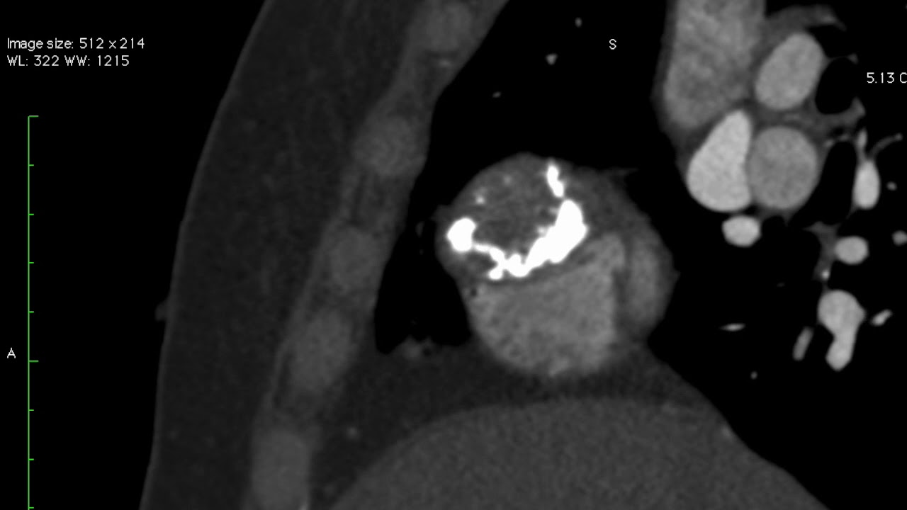 TMT: MEDIASTINAL CALCIFICATION CASE BASED REVIEW