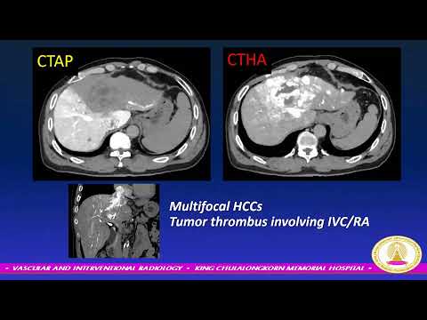 Augmentative diagnostic findings of IVR-CT