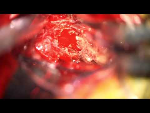 Eyebrow Olfactory Groove Meningioma with Endoscope Assistance