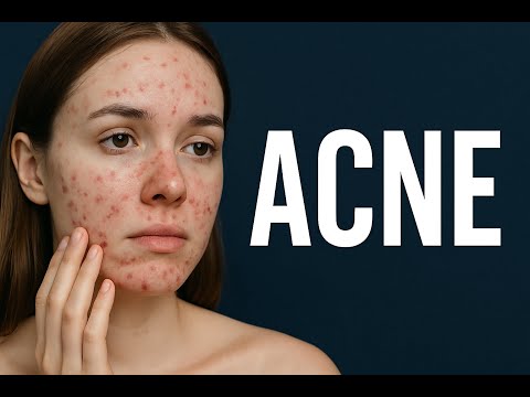 | Medical terminologies | diseases | acne | Meaning in Urdu and English | English vocabulary |