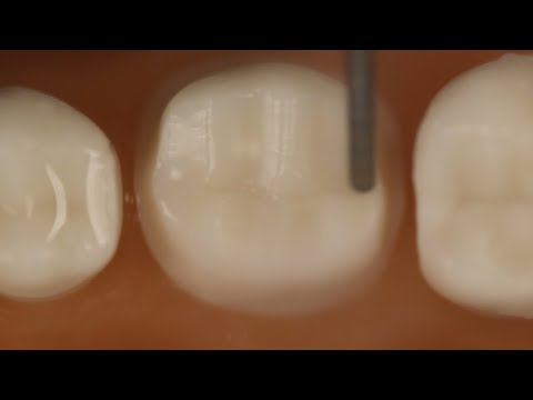 PFM Crown Posterior Tooth Preparation With Metal Occlusal