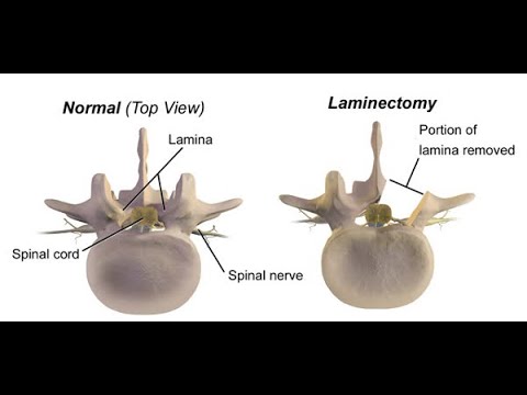 Laminotomy with decompression of nerve root CPT code - simplify medical coding