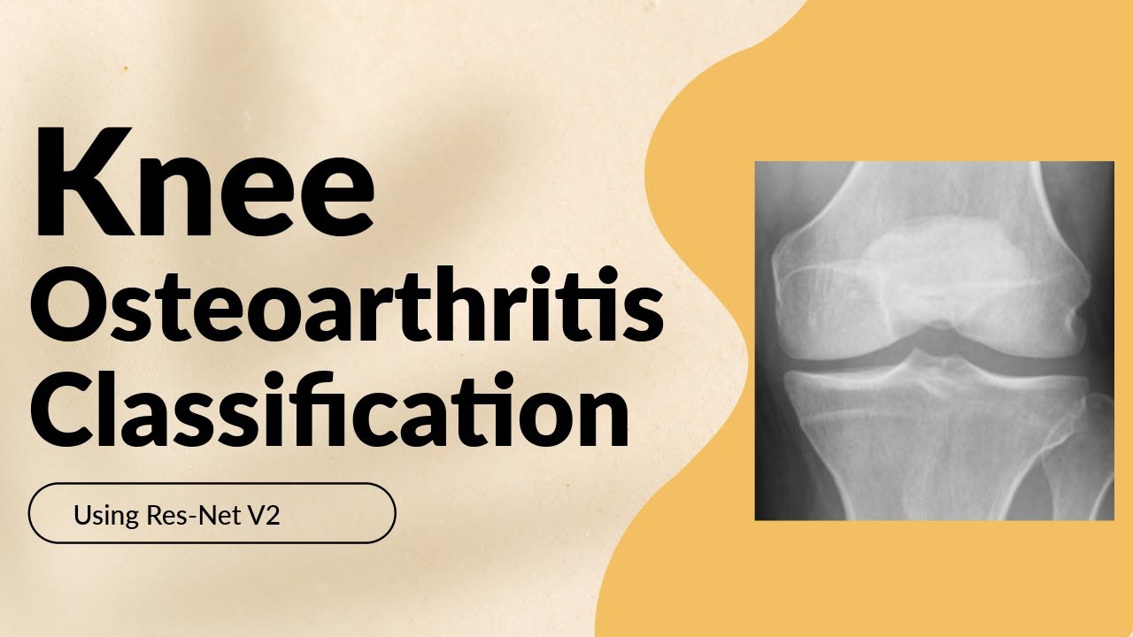 Knee Osteoarthritis Detection and Classification using Resenet
