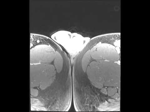 Normal testicular MRI