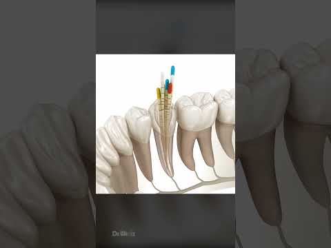 What To Expect During a Root Canal, Is It Right For You?