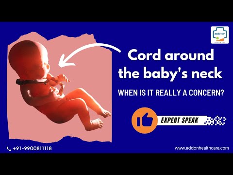 What is Cord around the baby's neck? | add-on Scans & Labs | Dr. Sunil Kumar G S