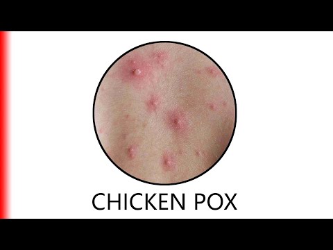 CHICKEN POX.