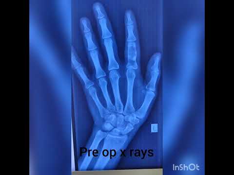 Hand swelling surgery ( Enchondroma of proximal phalanx )