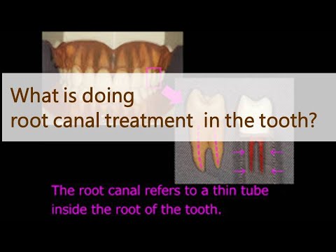 What is doing root canal treatment in the tooth?