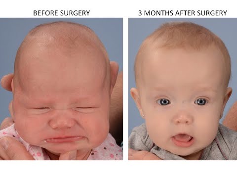 Craniectomy suboccipital CPT code - simplify medical coding