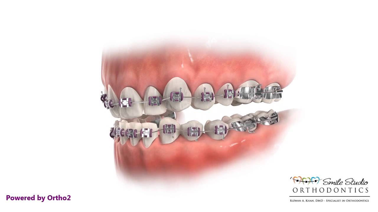 Bite Turbos - Orthodontic Treatment