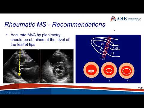 ASE Guideline: Recommendations for the Use of Echo in the Evaluation of Rheumatic Heart Disease